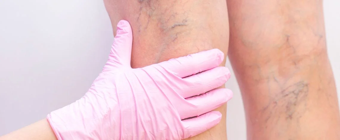 Proširene vene - što su i koji su simptomi - SEN